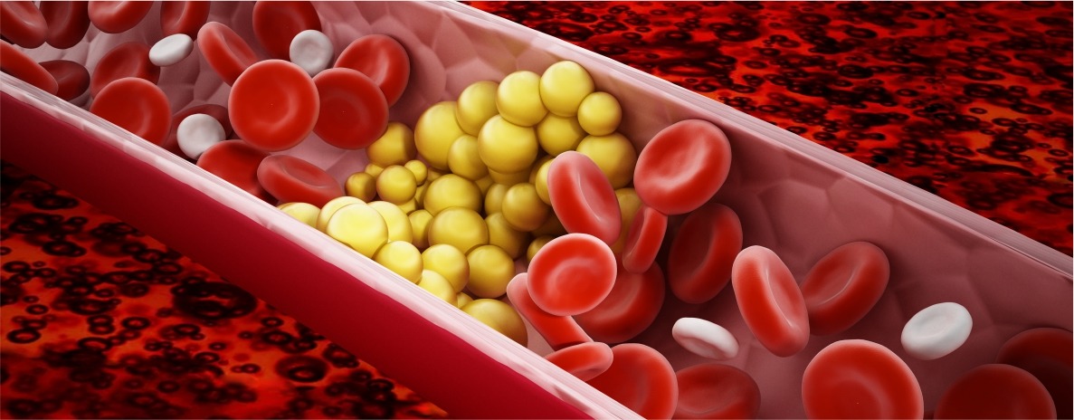 TRIGLICERÍDEOS ALTO: VEJA QUAIS SÃO OS RISCOS E COMO TRATAR - Montealtense